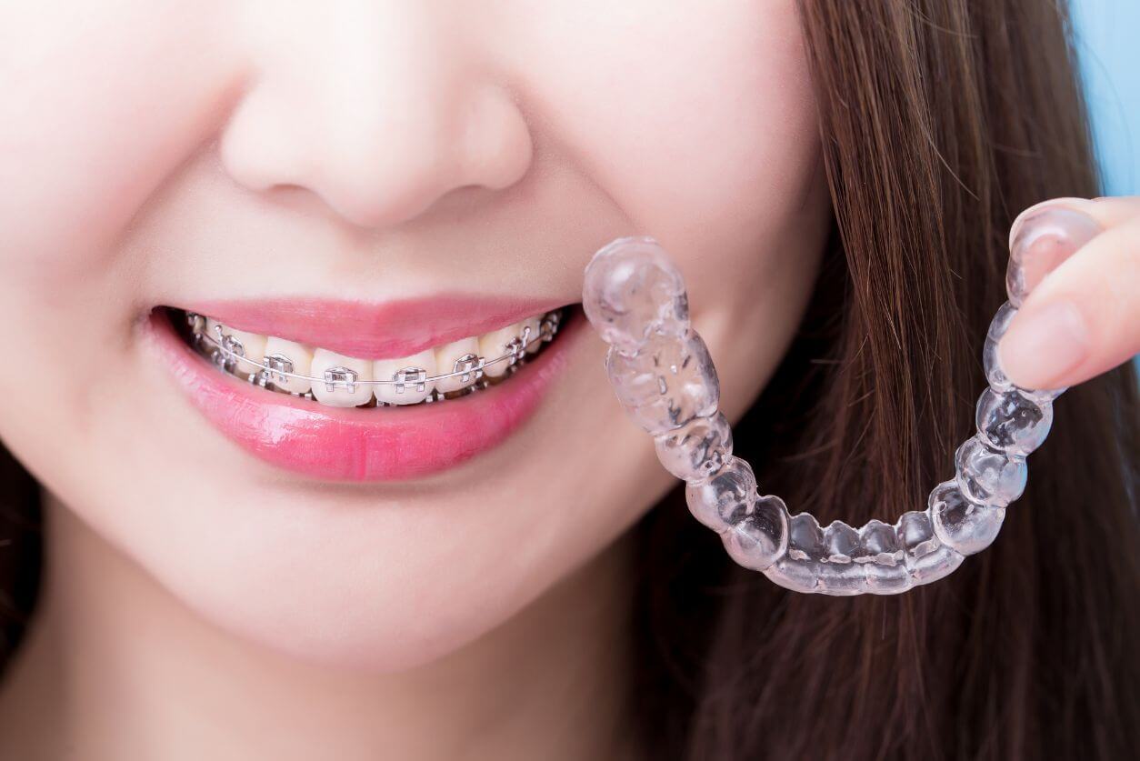 Invisalign vs Braces: Key Differences Explained